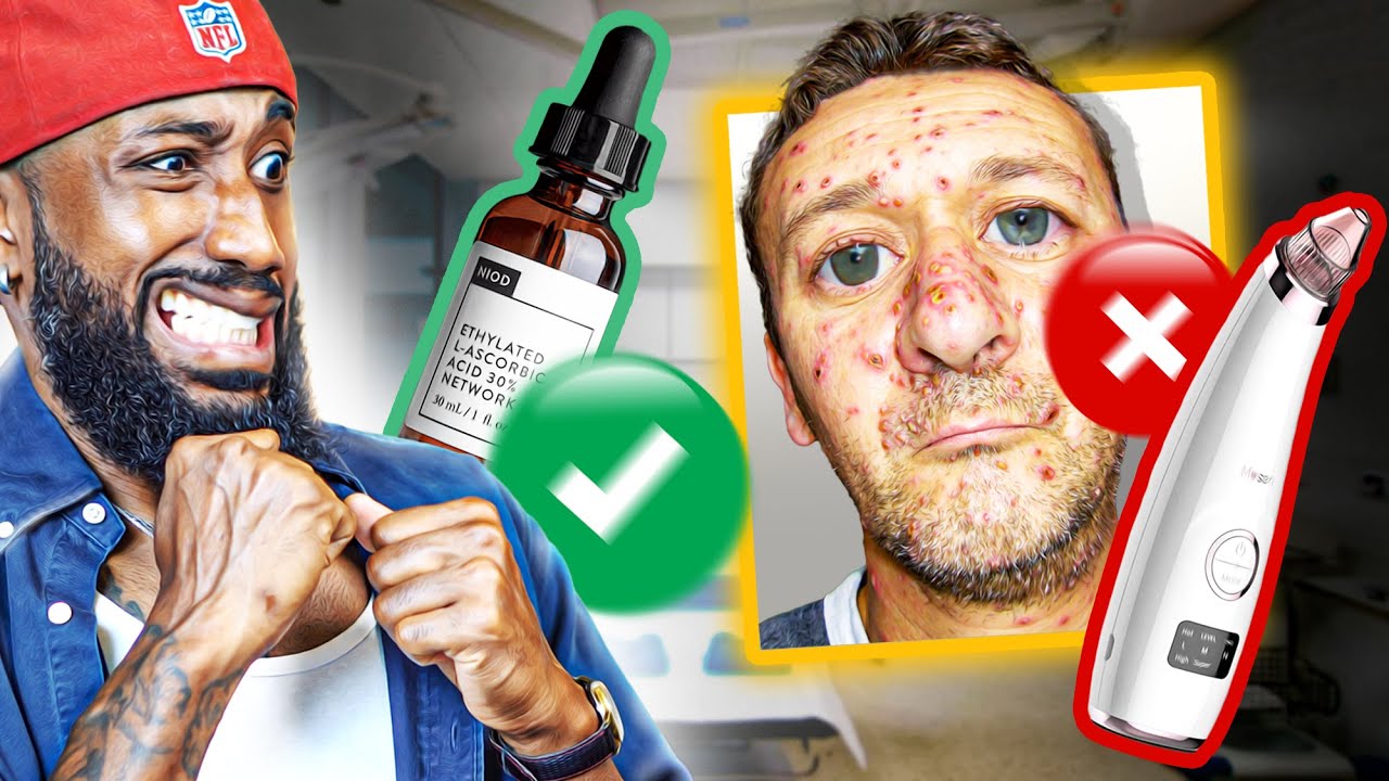 Solution points noirs sur le nez, peau grasse, boutons , exces de sebum ...