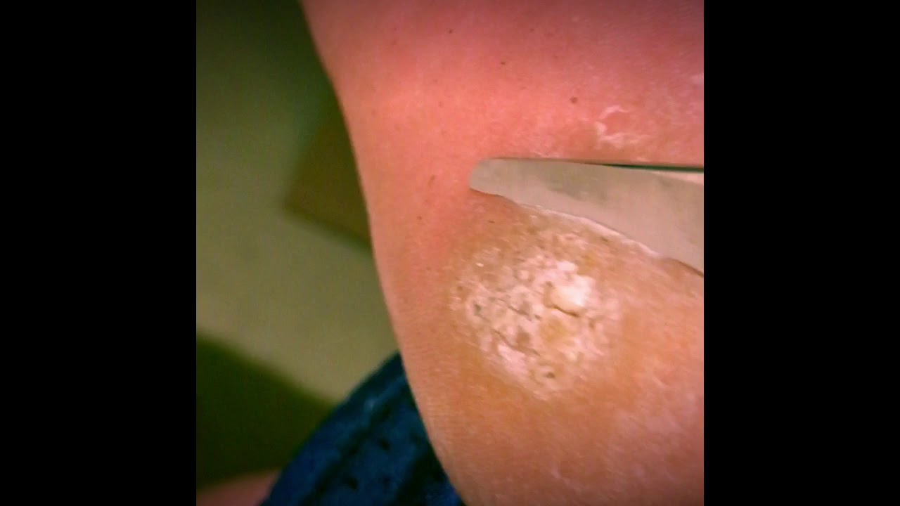 Big fart wart surgery part 10 - YouTube