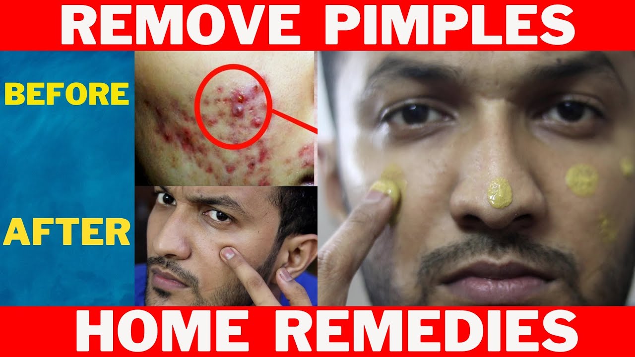 How To Remove Pimples Pimples Acne Treatment Home Remedies Youtube