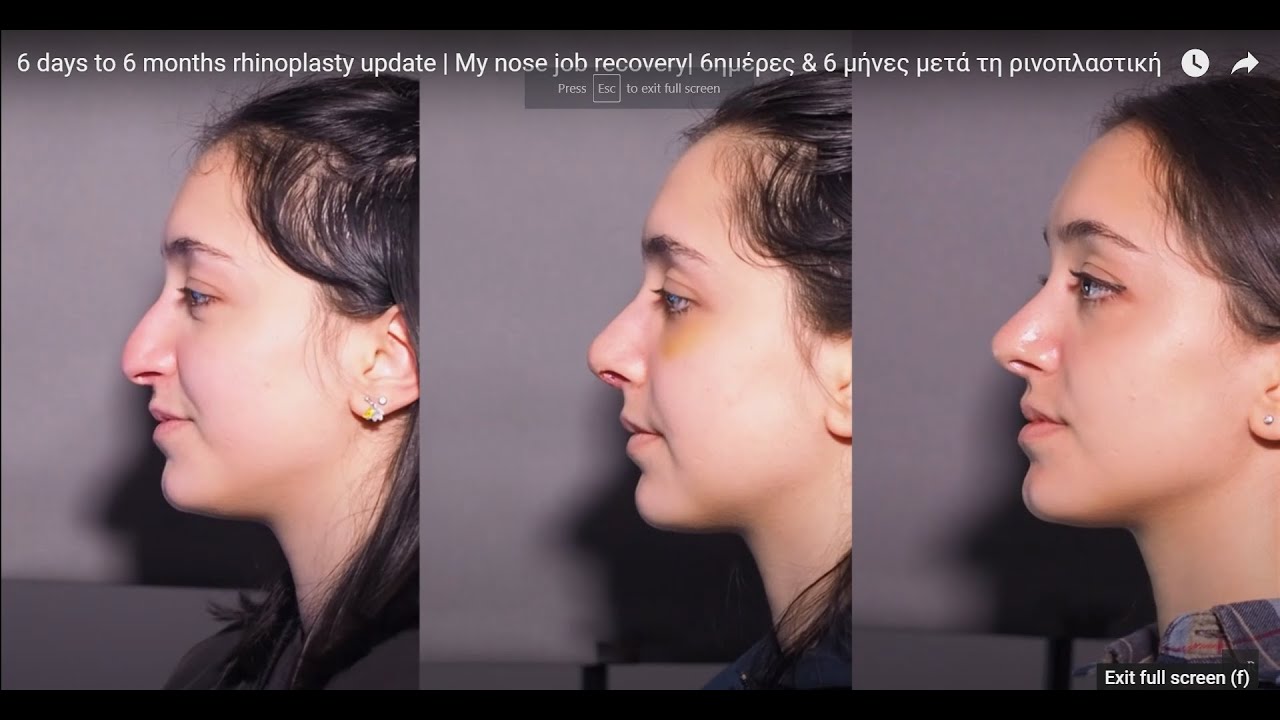 6 days to 6 months rhinoplasty update | My nose job recovery| 6ημέρες ...