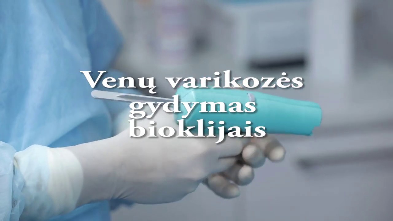 Venų varikozės gydymas bioklijais - YouTube