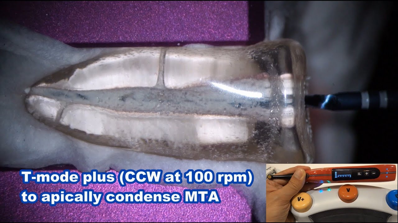MTA obturation procedure in a 3D printed tooth replica with 812MT/812MT ...