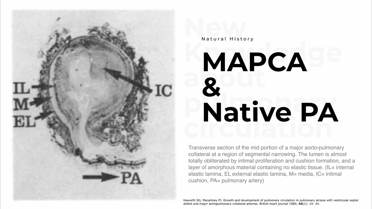 Tetralogy of Fallot, Pulmonary atresia with MAPCA in current practice ...