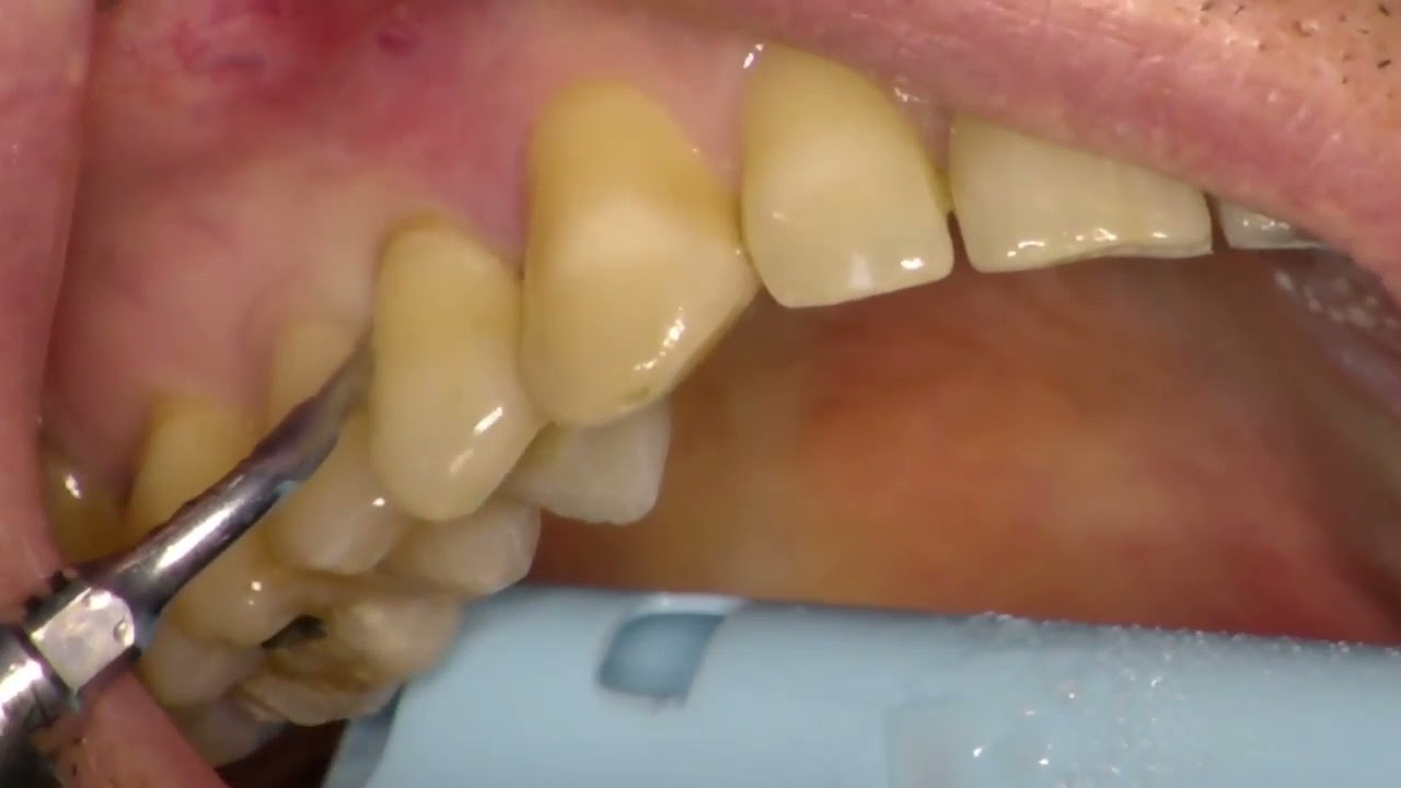 Bilateral Teeth Fracture Dr Abdah - YouTube