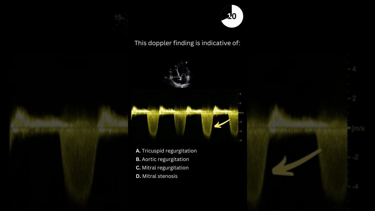 Echocardiography board practice question #11 - YouTube