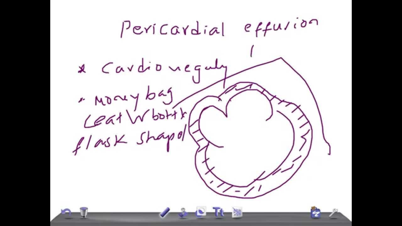 QUICK RADIOLOGY: Radiologic signs of Pericardial effusion - YouTube