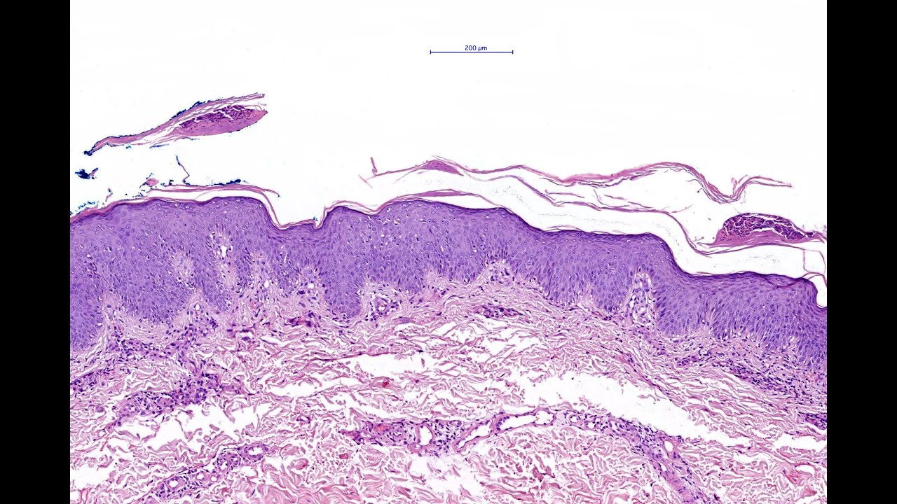 Guttate psoriasis Phillip McKee, Antonina Kalmykova & CSD Health Care ...