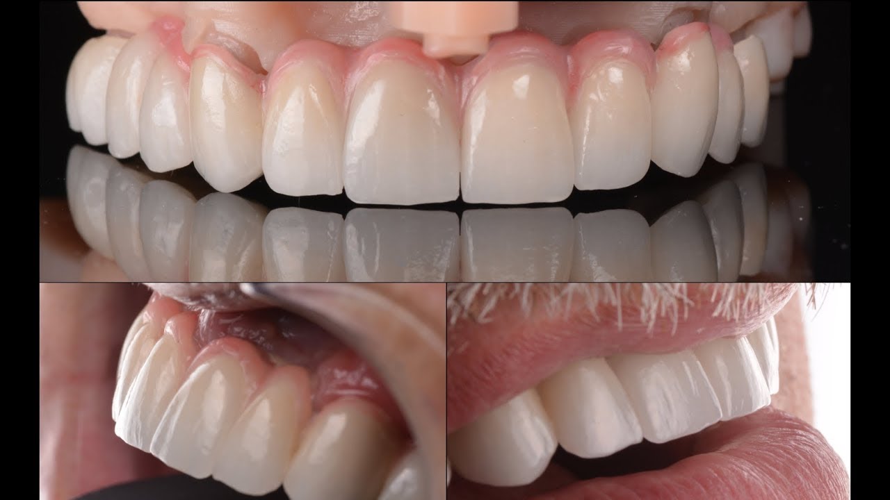 Intraoral scanner PEEK / PEKTON Vitablocs Veneers (Carestream Dental ...