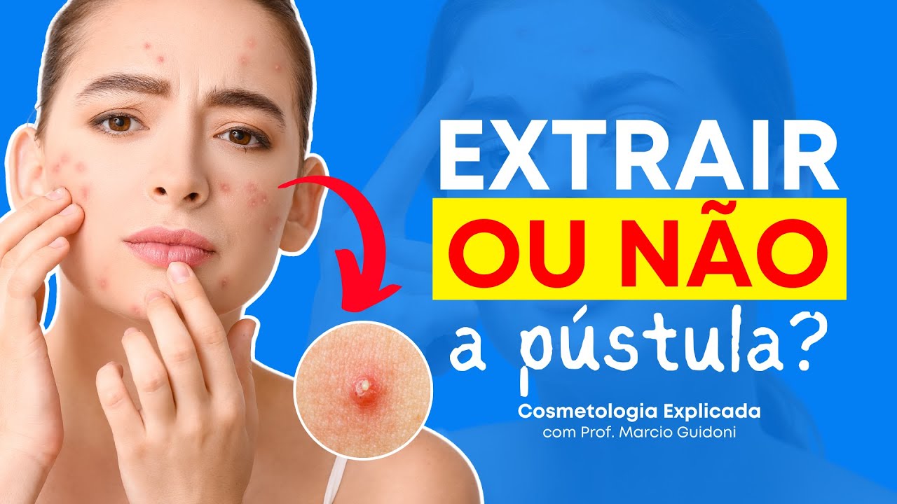 EXTRAIR OU NÃO A PÚSTULA? | Cosmetologia Explicada com Prof. Marcio ...