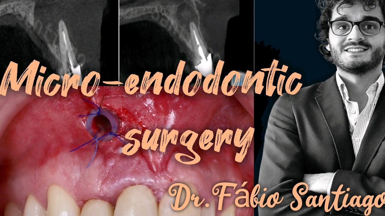 Micro - endodontic surgery. Endodontic treatment. Dr. Fábio Santiago ...