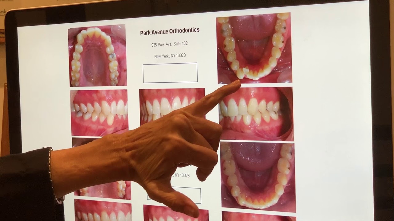 Using Invisalign to Treat Deep Overbite - YouTube