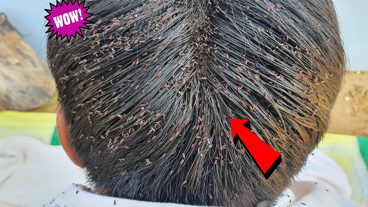 Thousand lice on head's boy removal - Lice comb - YouTube