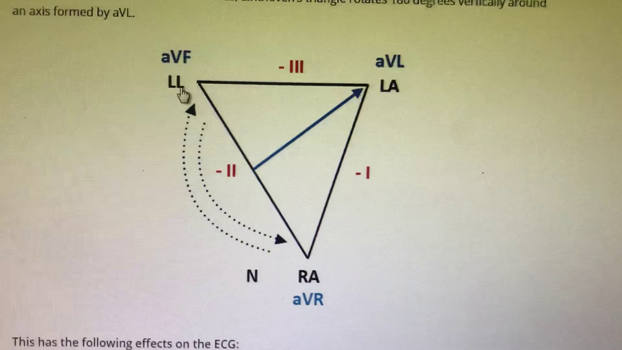 ECG lead reversal - YouTube