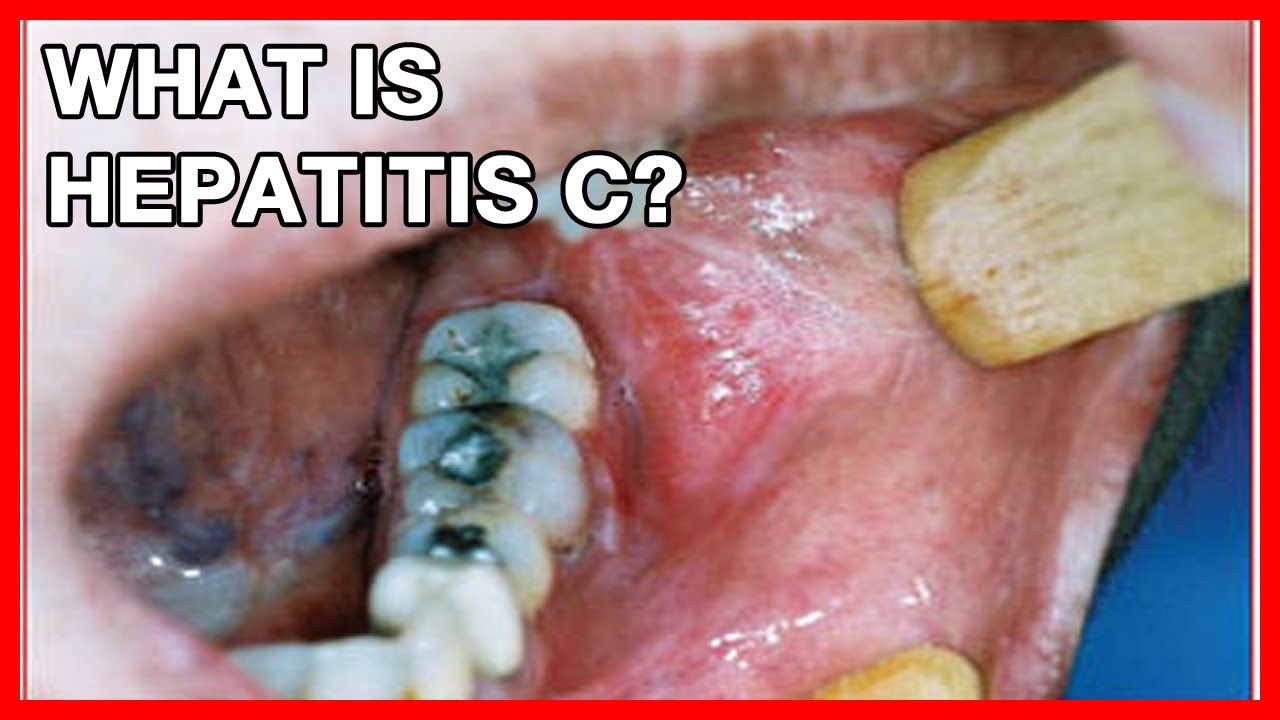 What Is Hepatitis C Transmission Health Risks Symptoms And Cure