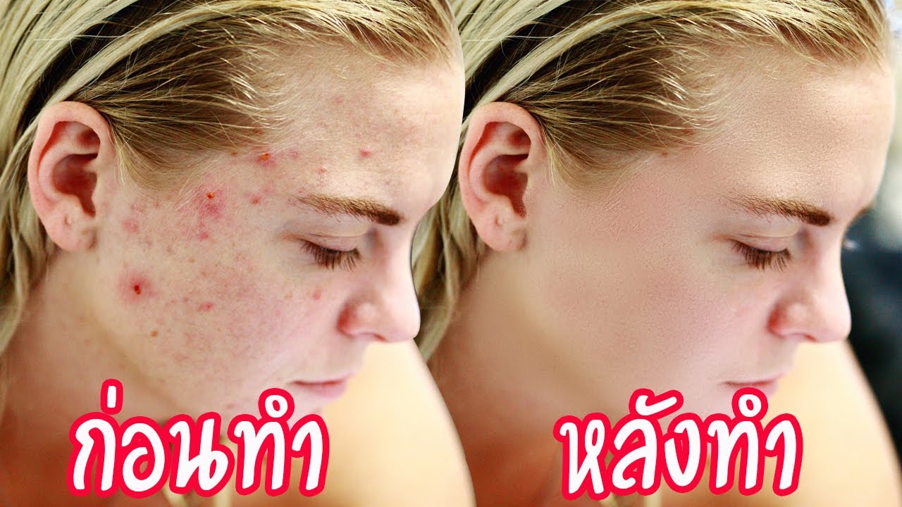 ลบสิว photoshop 2020 - YouTube