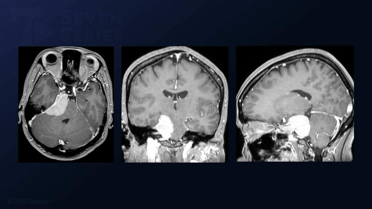 Resection of a Petroclival Meningioma through the Extended Retrosigmoid ...
