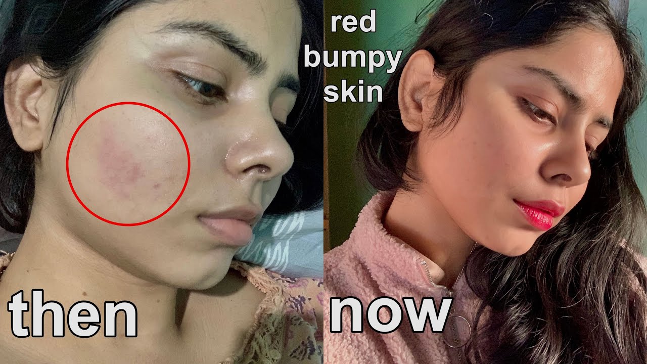 5 Reasons Why Your Skin is Red & Bumpy and How to Fix that - YouTube