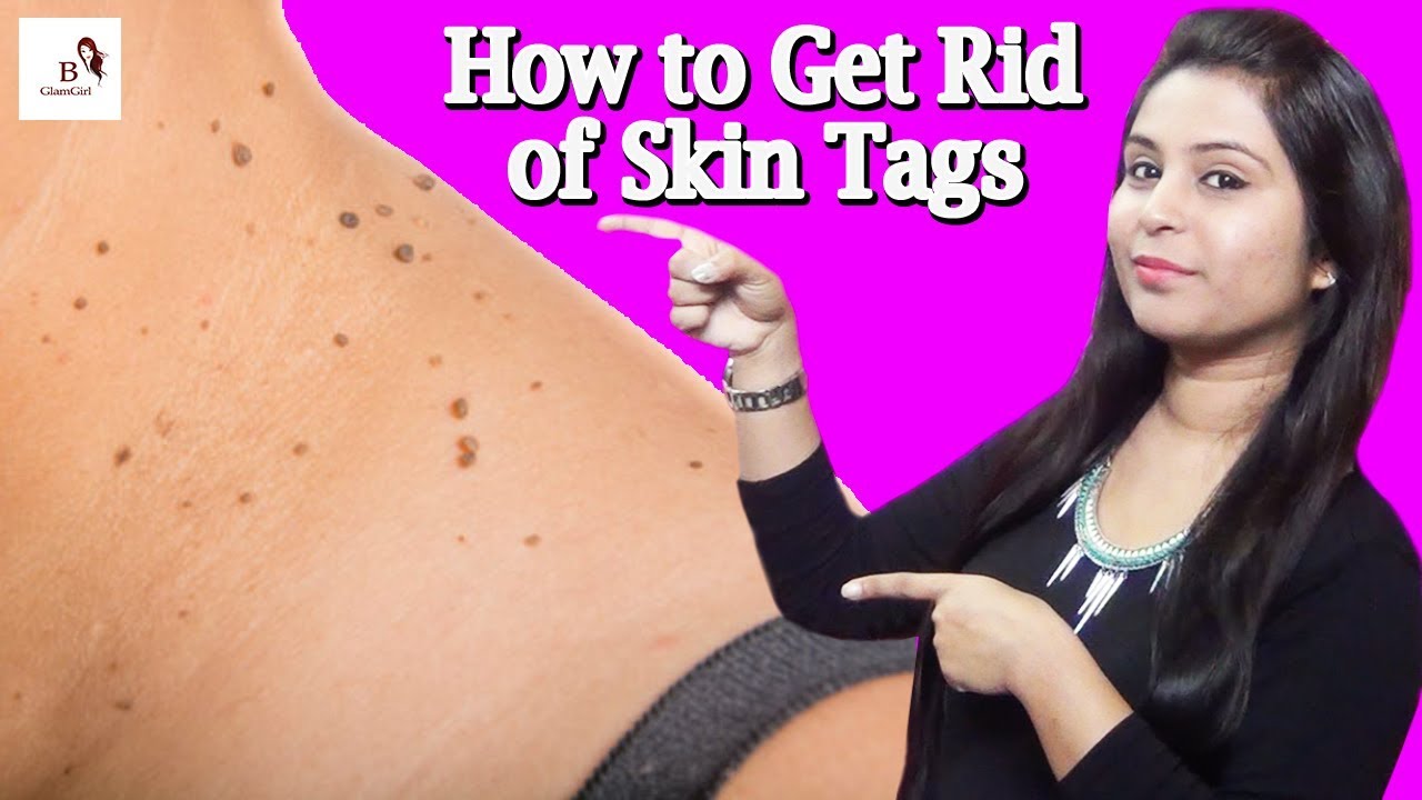 Remove Skin Tags in 1 Night By Applying Garlic - Natural Home Remedies ...