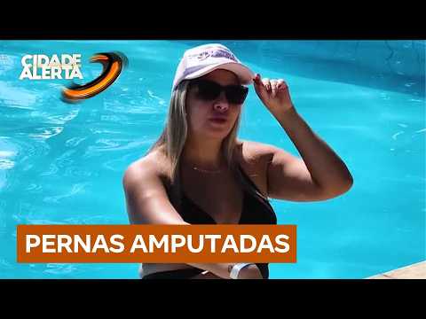 Cirurgia plástica termina com amputação das pernas de mãe de três filhos