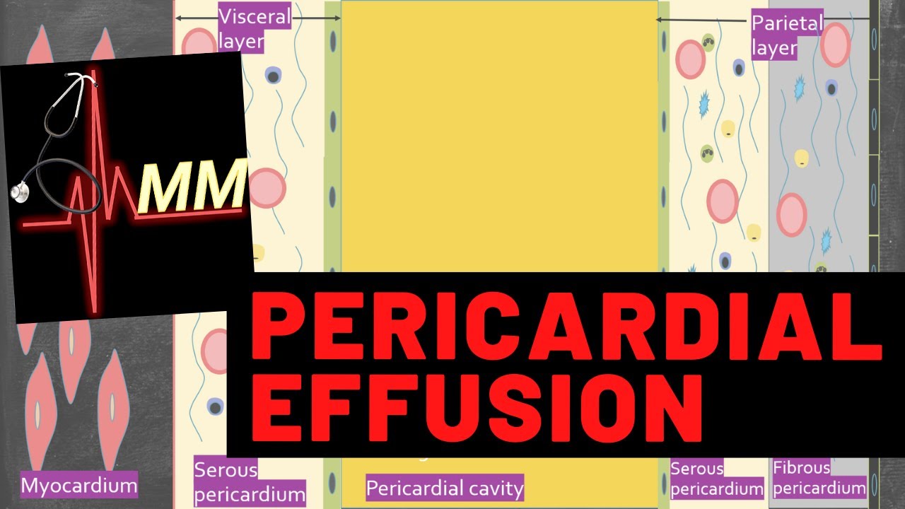 Pericardial Effusion pathogenesis | Understanding Pericardium ...