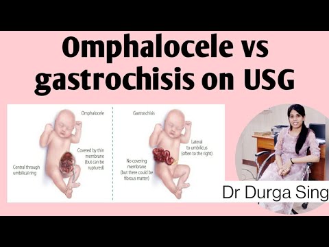 Omphalocele vs gastrochisis on USG - YouTube