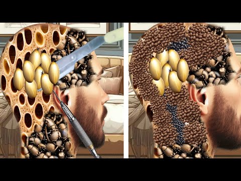 ASMR Remove Scorpion and trypophobia infected Scalp / ASMR treatment ...