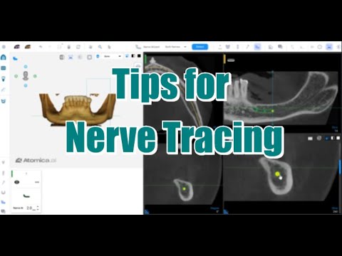Implant Planning Basics  (Atomica AI) - Step 5. Nerve Tracing