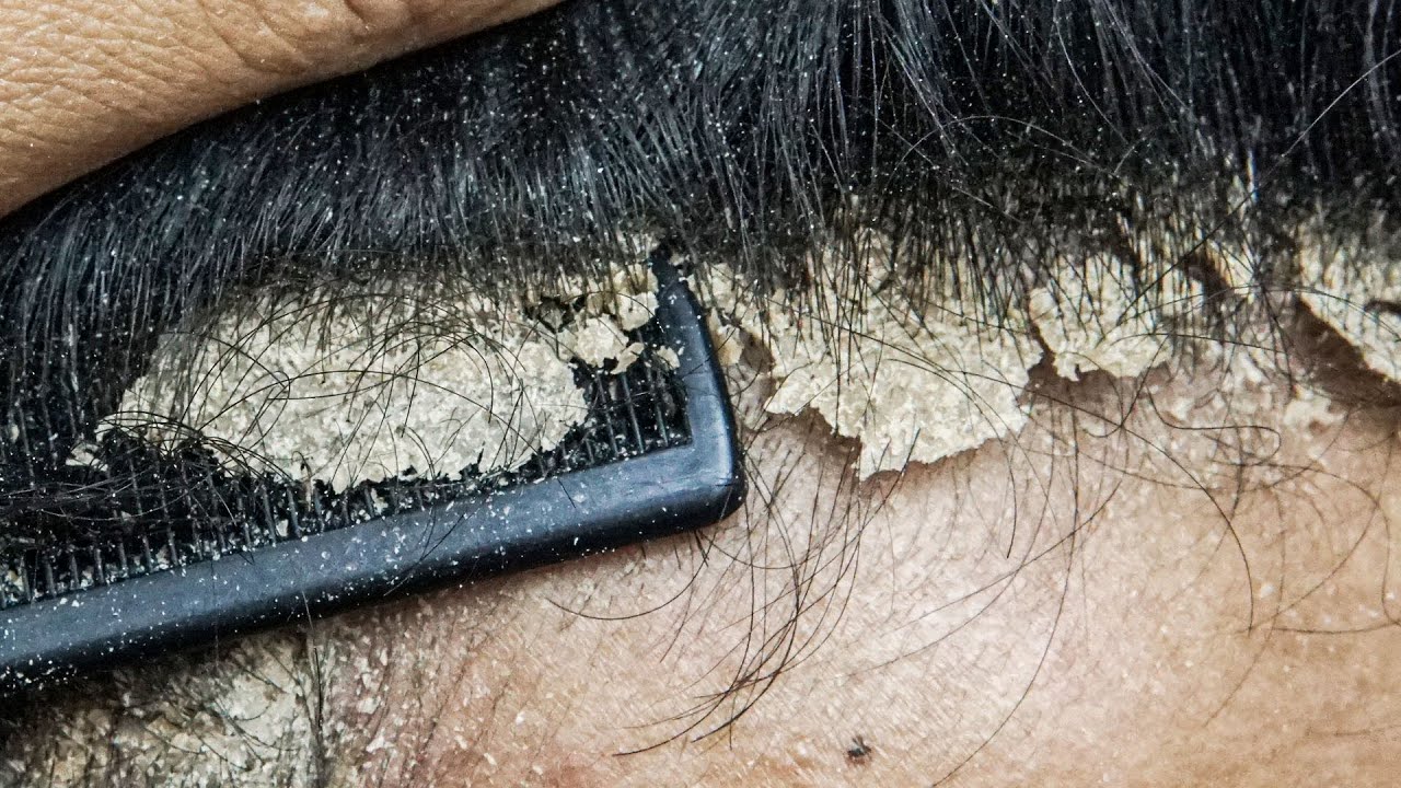 Combing And Scratching Dandruff Off Scalp #1177 - YouTube
