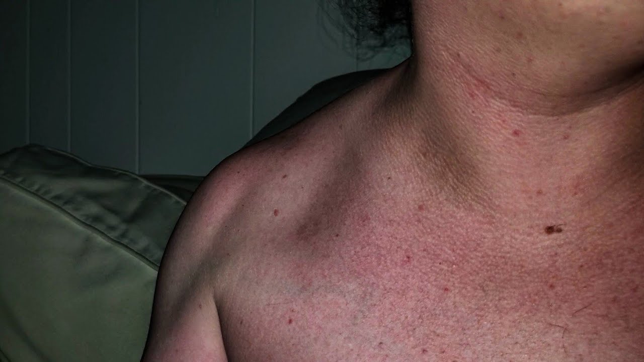 Shoulder Blade Grinding Sounds During Movement - YouTube