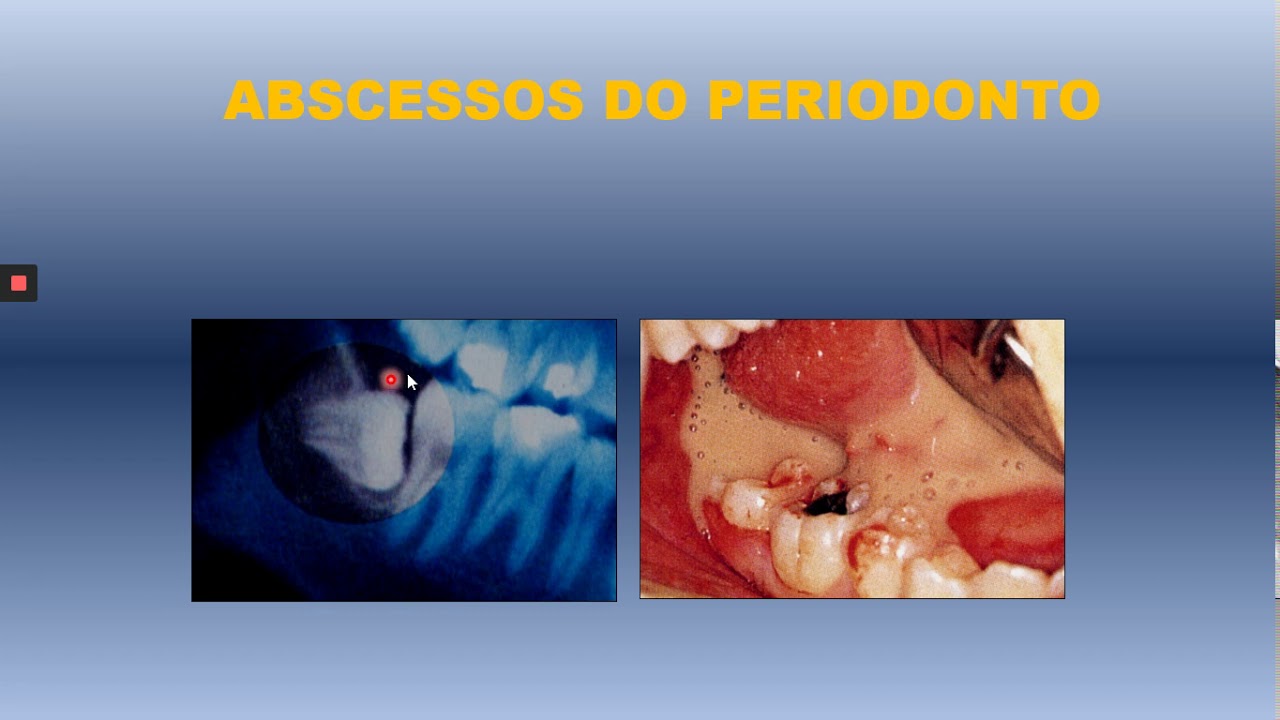 VIDEOAULA ABSCESSO PERIODONTAL - YouTube