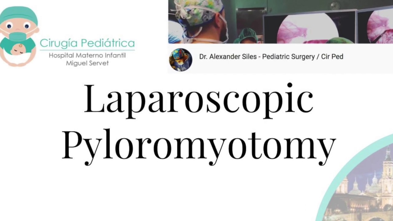 Laparoscopic pyloromyotomy in Pediatric Surgery / Piloromiotomía ...