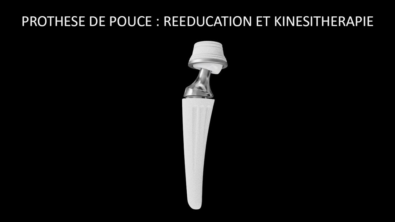 PROTHESE DE POUCE, REEDUCATION, KINESITHERAPIE - YouTube