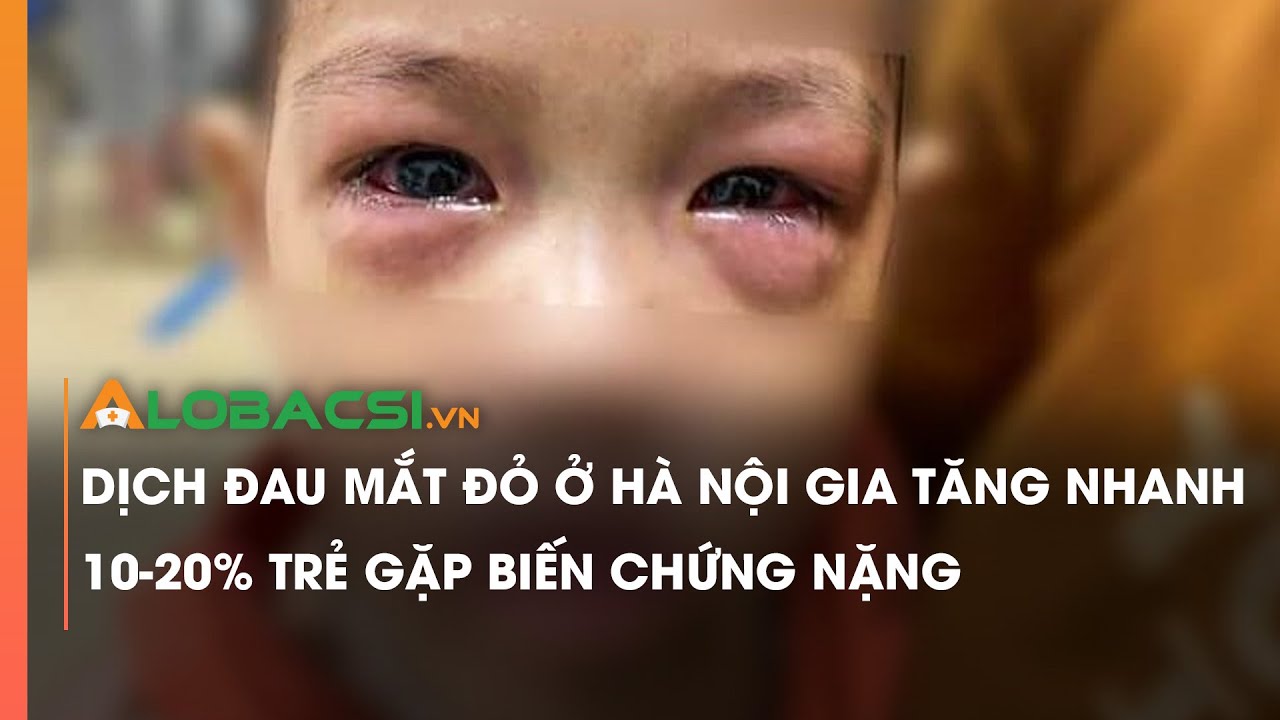 Dịch đau mắt đỏ ở Hà Nội gia tăng nhanh, 10- 20% trẻ gặp biến chứng ...