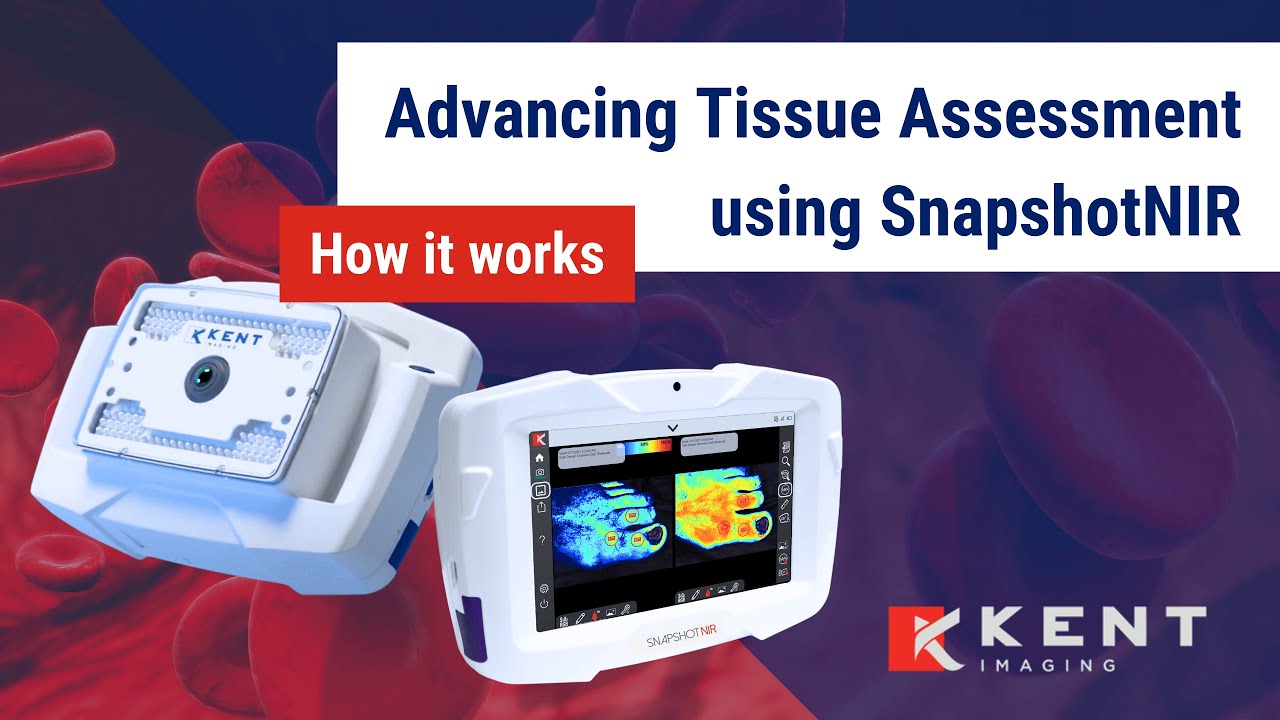 How SnapshotNIR is Advancing Tissue Assessment - A Kent Imaging ...