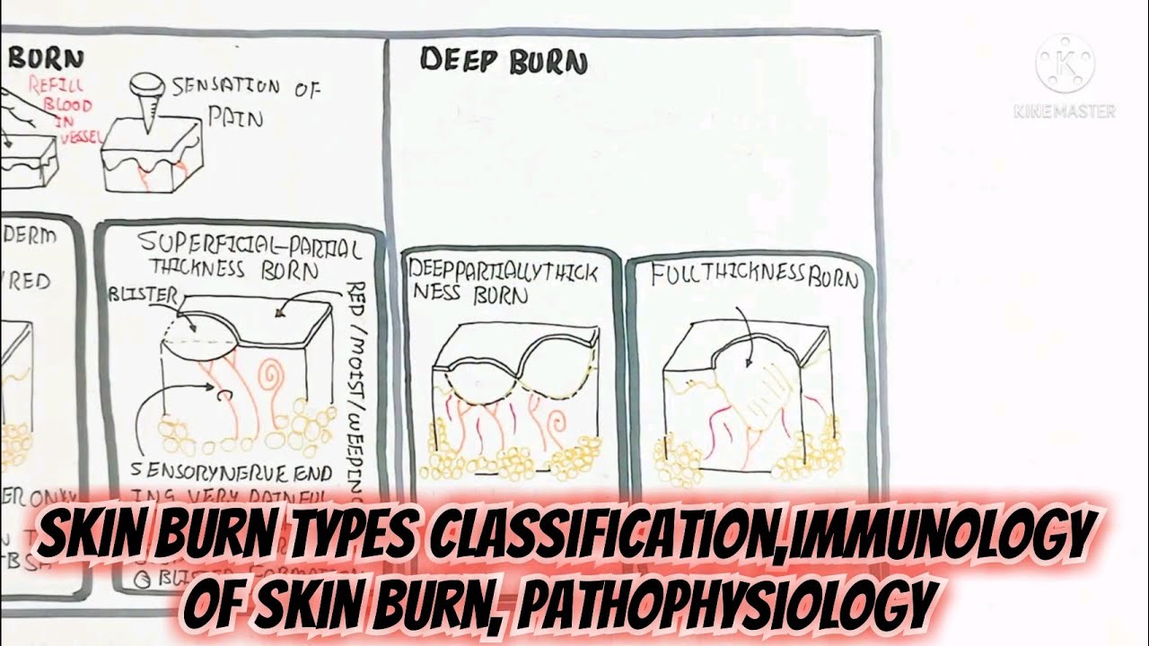 skin burn types classification/calculation/immunology of skin burn ...