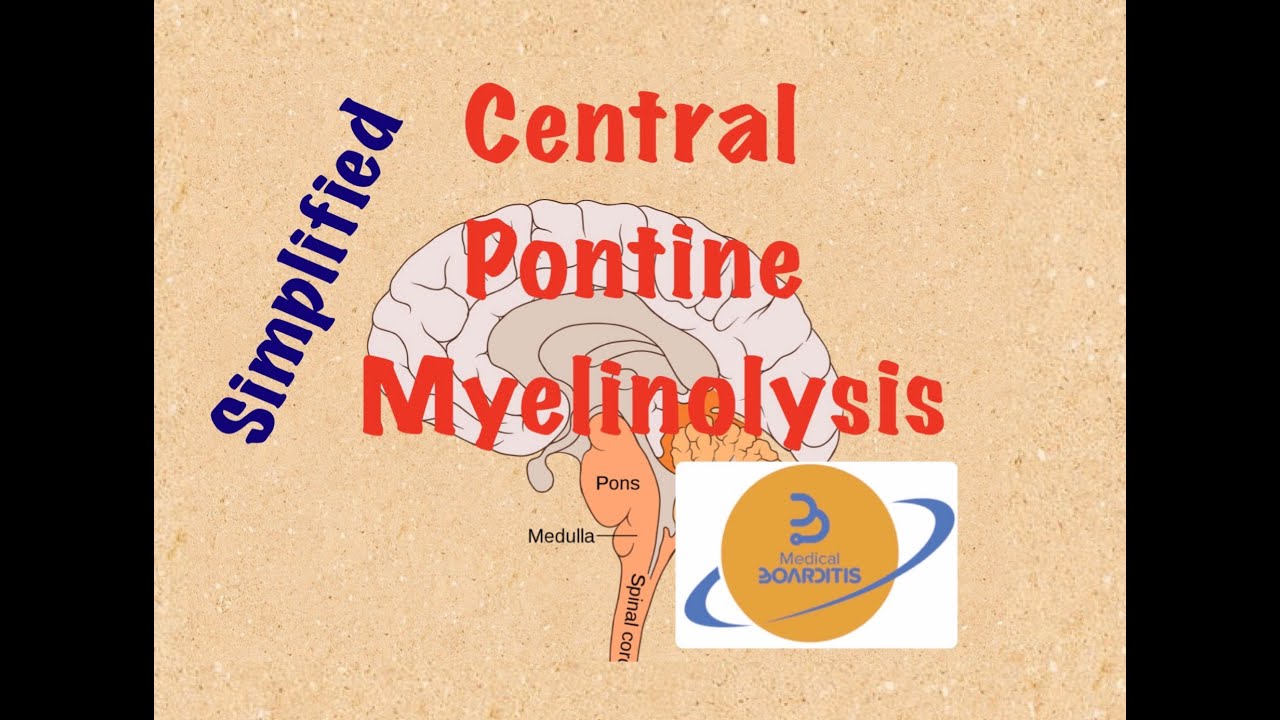 Central Pontine Myelinolysis, Osmotic Demyelination Syndrome ...