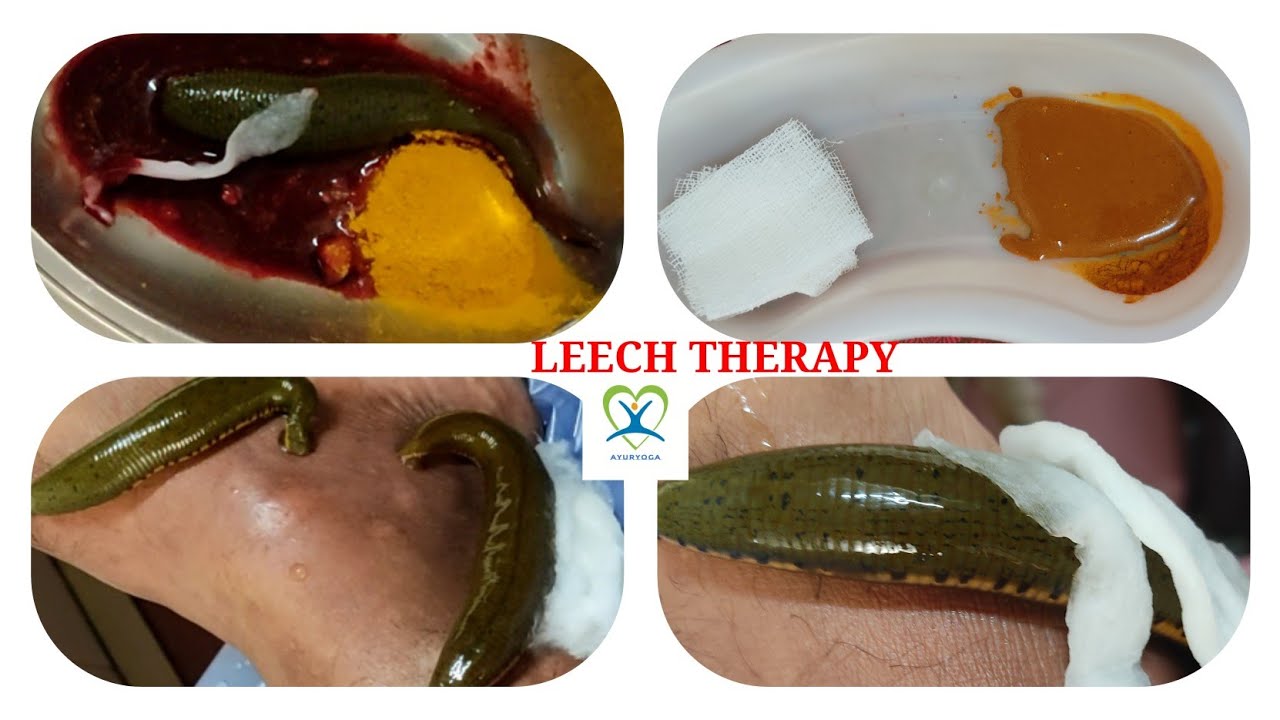 Jaloka | Leech Therapy |Full Procedure | Panchakarma - YouTube