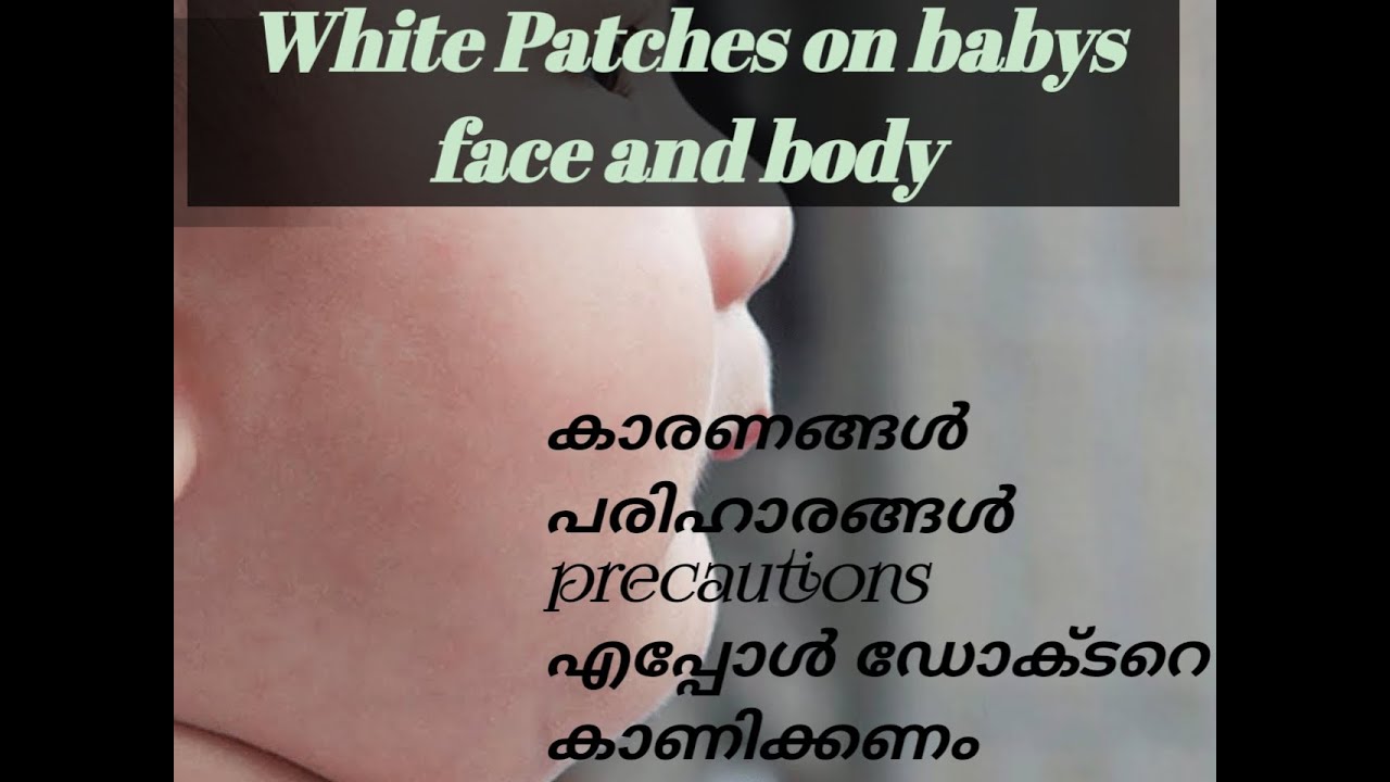 White Patches On Baby s Face And Body White Spot YouTube white-patches-on-baby-s-face-and-body-white-spot-youtube