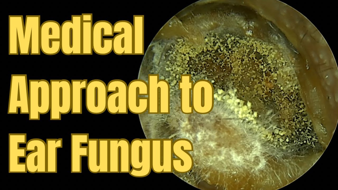 Medical Approach to Ear Fungus - YouTube