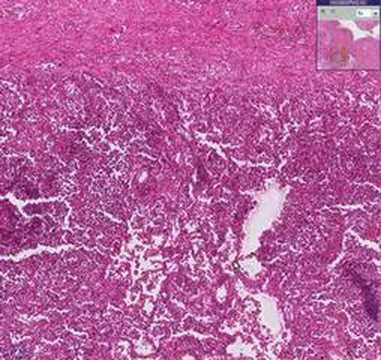 Histopathology Lung--Abscess, bronchopneumonia - YouTube