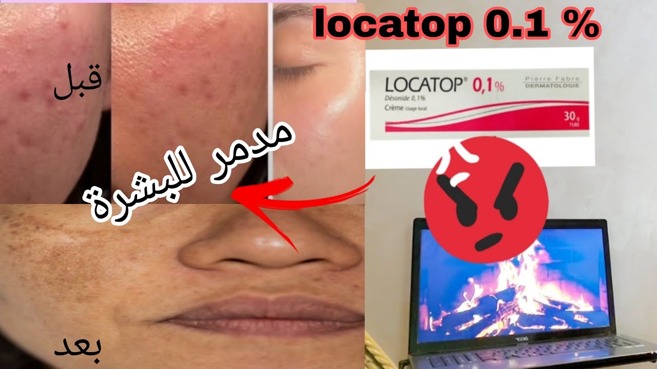 الأتار الجانبية حداري من ️ locatop 0.1% ️ لعلاج أتار الحبوب للبشرة ...
