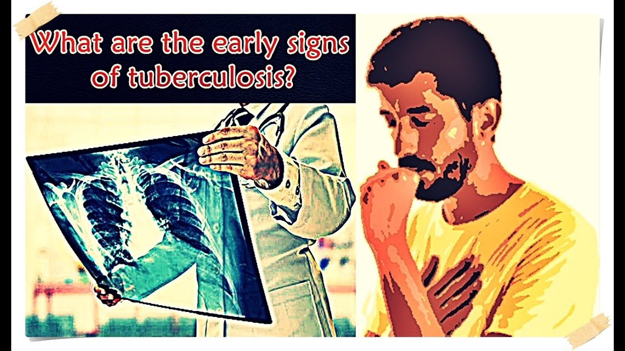 Positive TB Test What Does It Look Like YouTube positive-tb-test-what-does-it-look-like-youtube