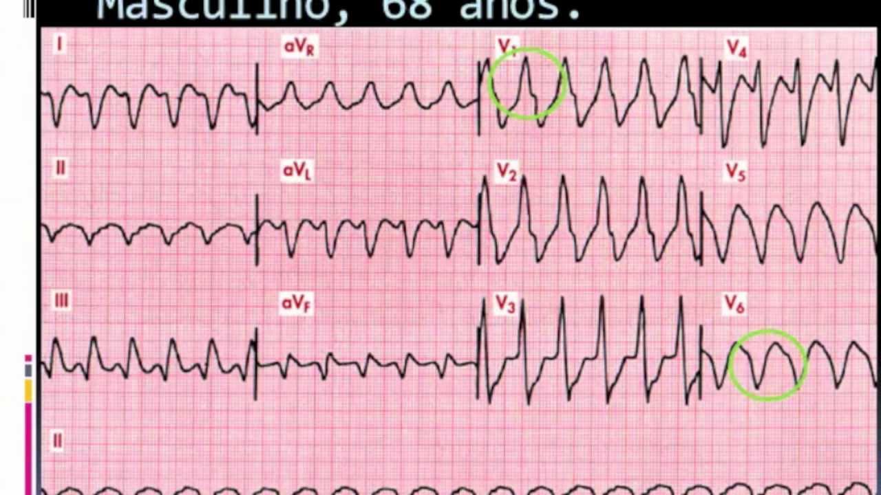 www.ecgepm.com: Video aula de eletrocardiograma baseada em casos ...