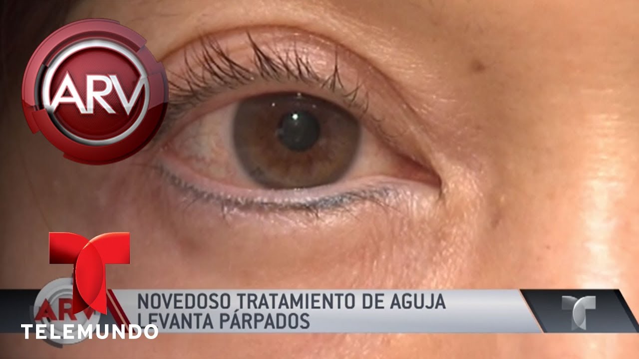 Llegó un novedoso tratamiento para los párpados caídos | Al Rojo Vivo ...
