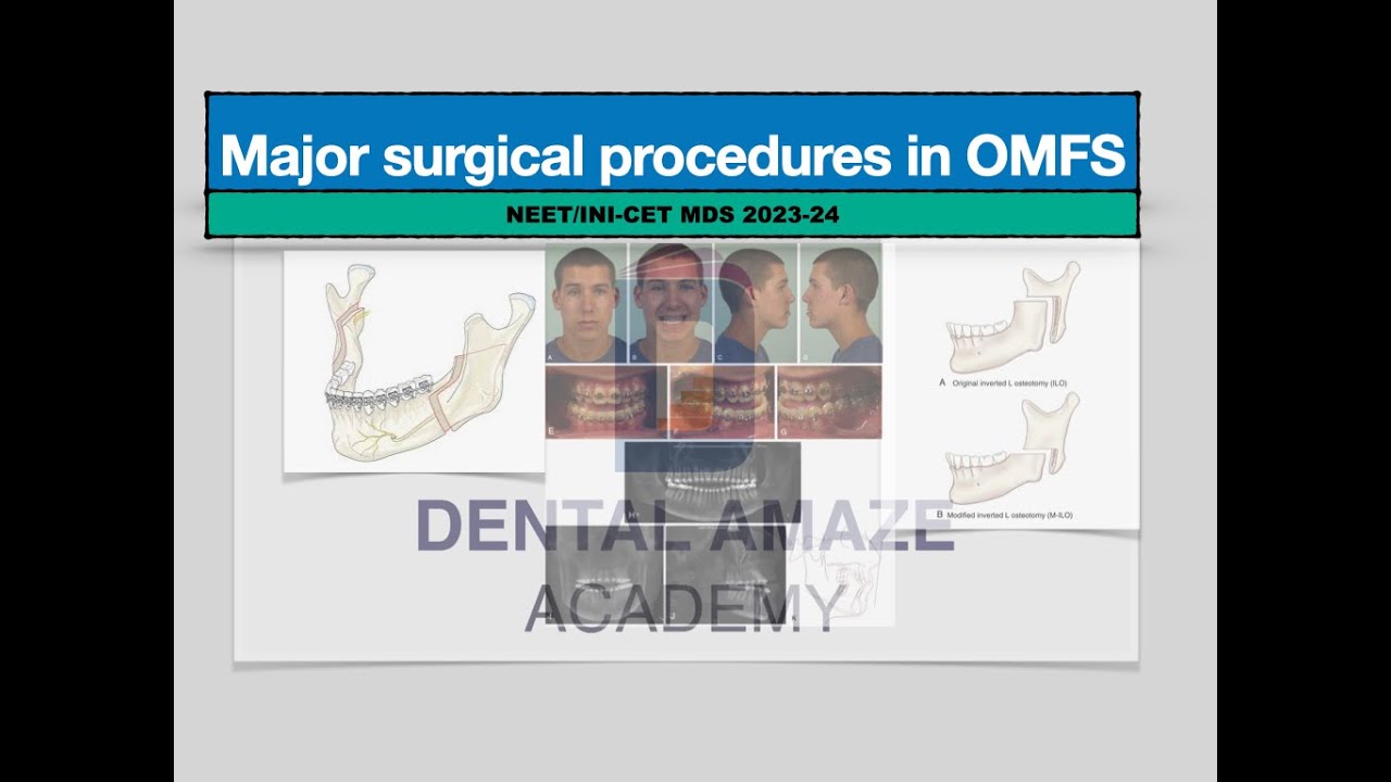 Major surgical procedures in OMFS - YouTube