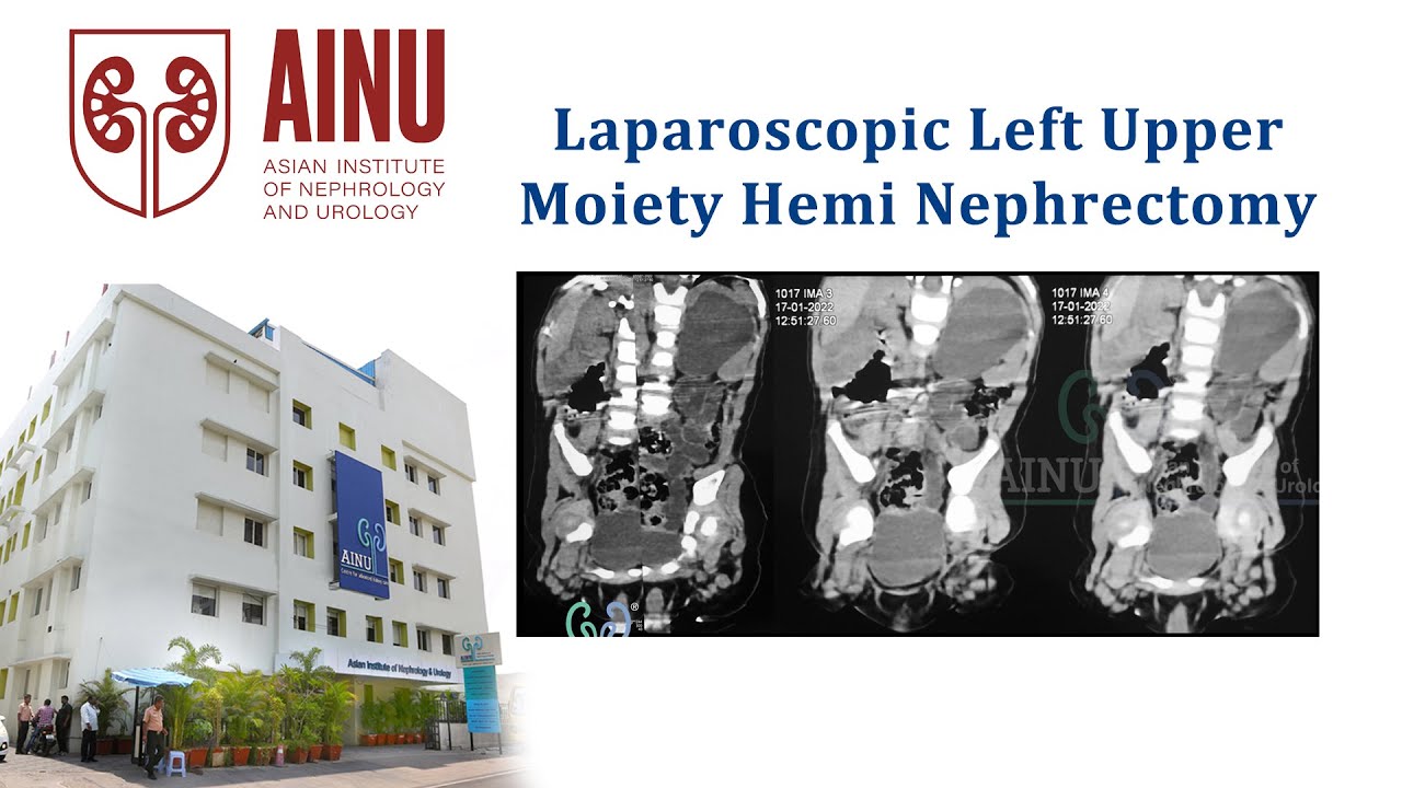 Lap Left Upper Moiety Hemi Nephrectomy | Surgical Video - YouTube