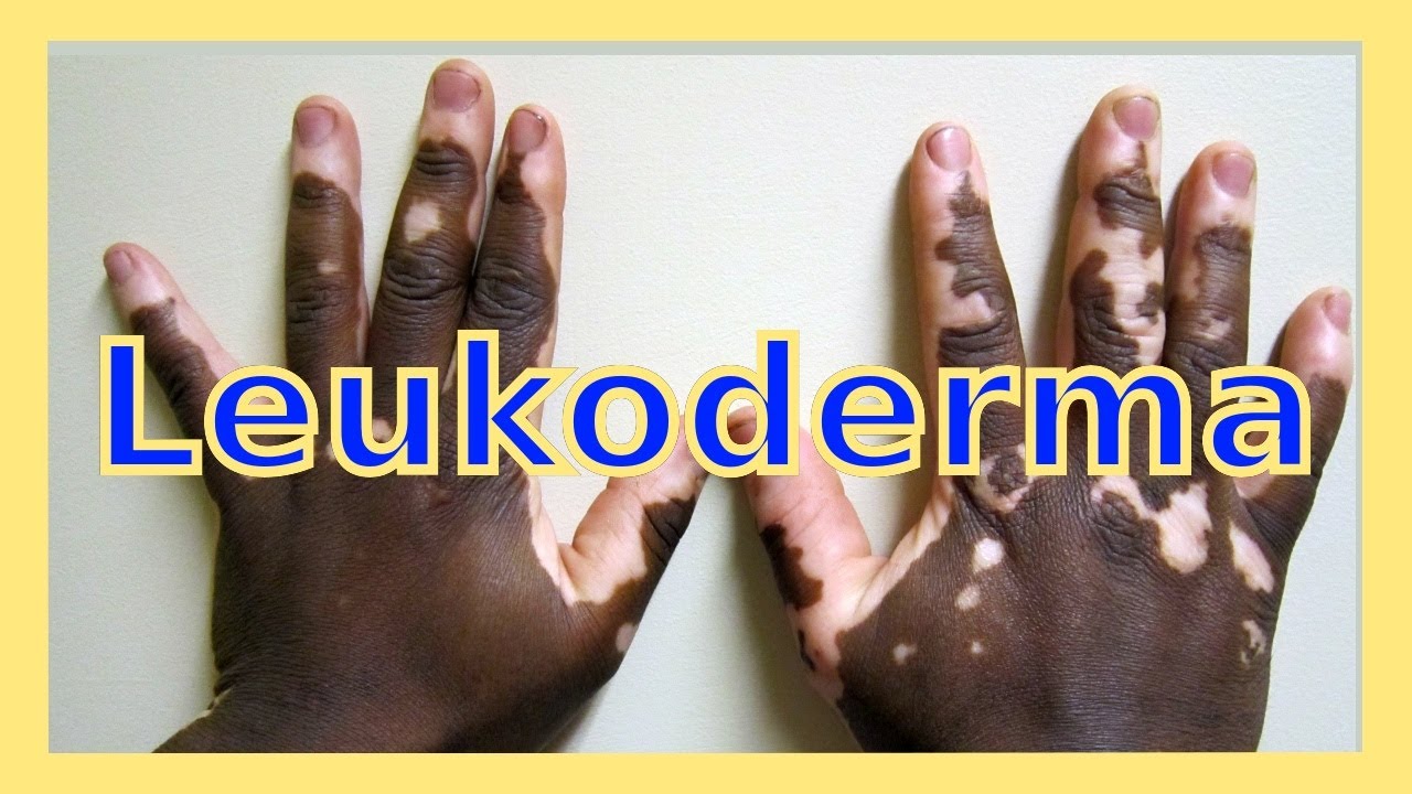 leukoderma - YouTube