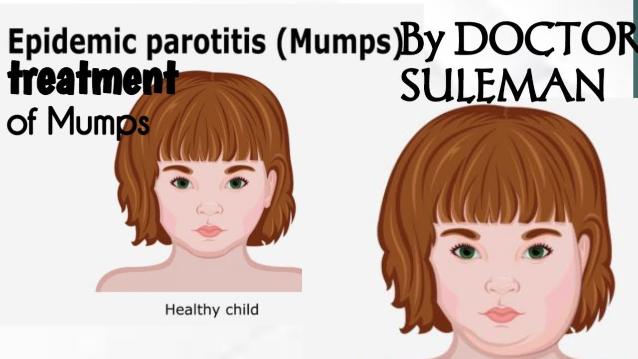 Mumps|Signs,symptoms and treatment of Mumps|viral infection|Mumps ...