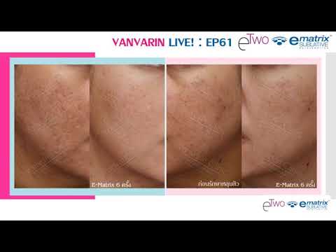 Vanvarin Live! EP61 : รักษาหลุมสิวด้วยเครื่อง ETwo-Ematrix💡💡 - YouTube