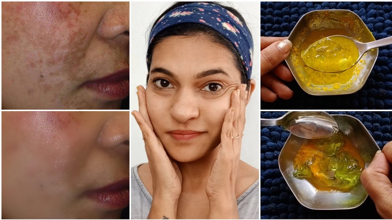 Lighten Pigmentation From Face | Remove Dark Spots, Pigmentation, Hyper ...